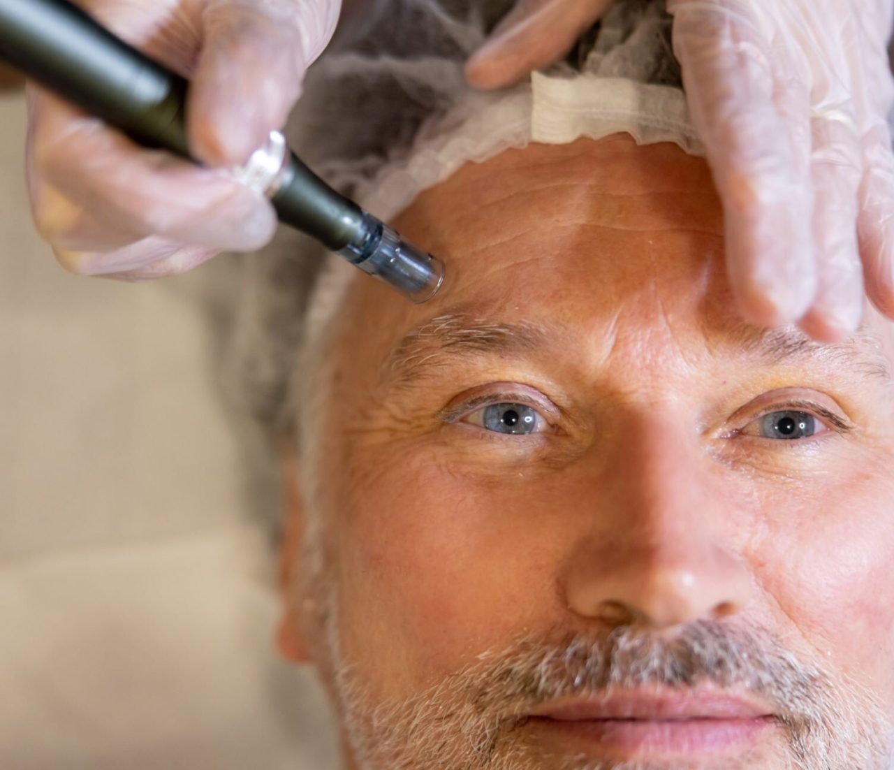 Micro-Needling - Eudai Clinic